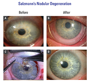 Salzmann Nodular Degeneration